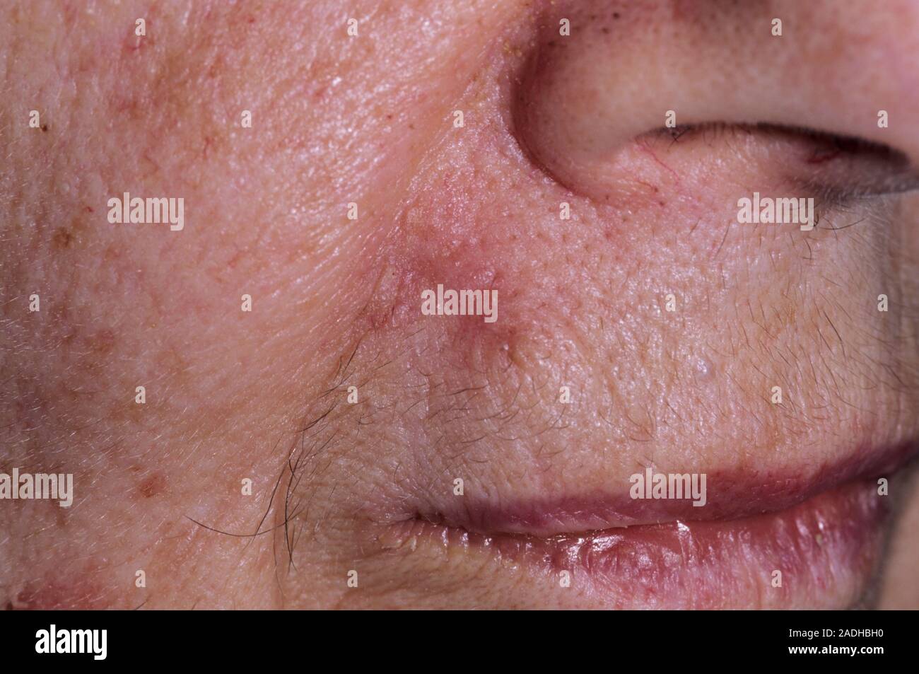 Skin cancer removal. Reddened area (centre) indicating site of a basal ...