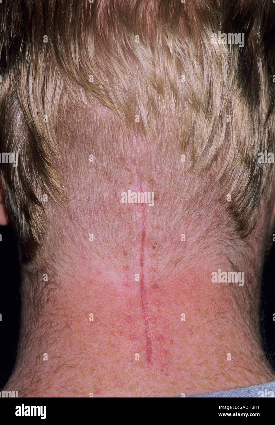 Cancer removal. Scar on the neck of a 25-year-old man, two weeks after ...