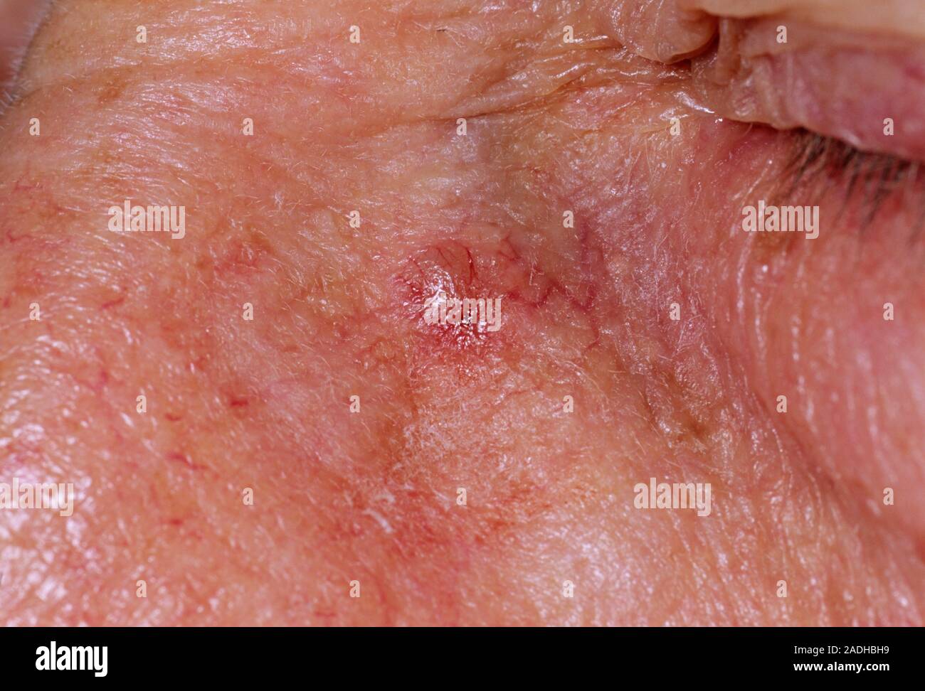 Skin cancer. Basal cell carcinoma (BCC), or rodent ulcer, on the cheek ...