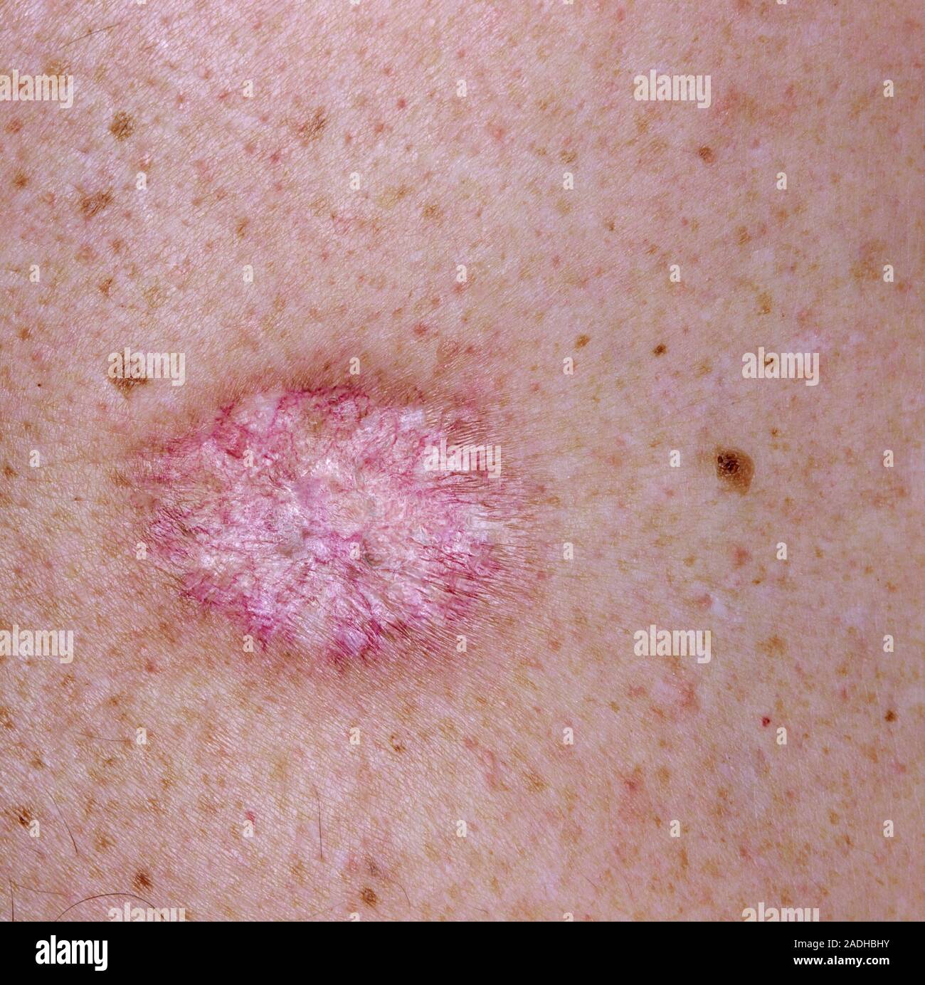 Skin cancer. Scar from a basal cell carcinoma after radiotherapy ...