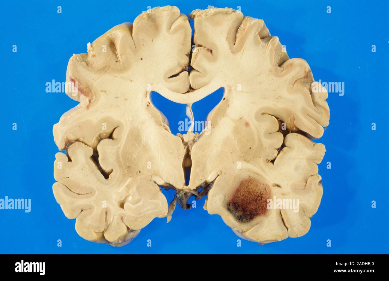 Secondary brain cancer, gross specimen. Brain slice showing a ...