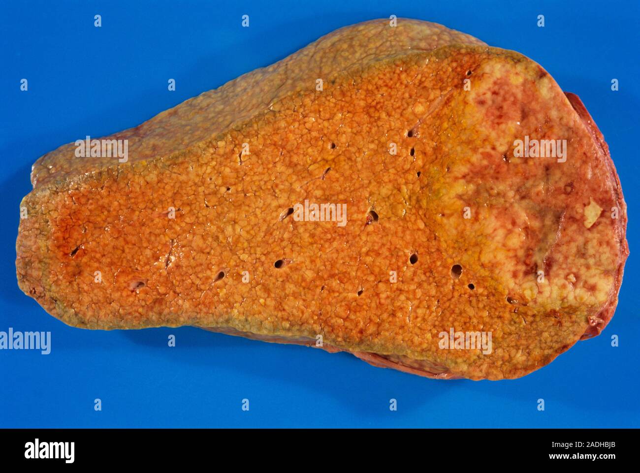Liver cancer. Gross specimen of a liver with hepatic cancer and ...