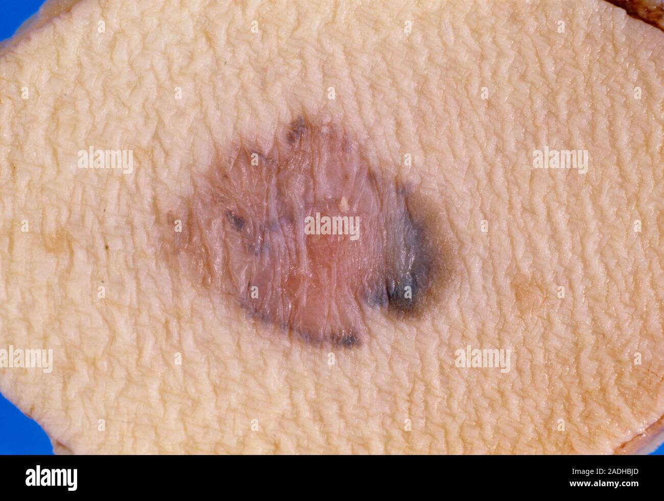 Skin cancer. Gross specimen of a malignant melanoma (dark area), a type ...