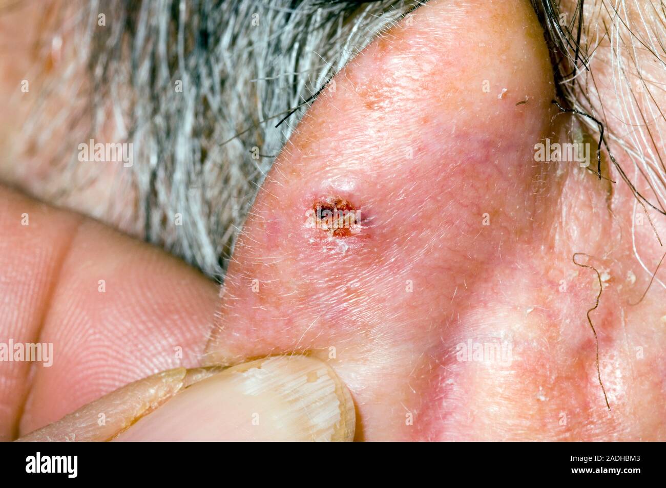 Basal cell carcinoma (BCC), or rodent ulcer, on the back of a 79 year ...