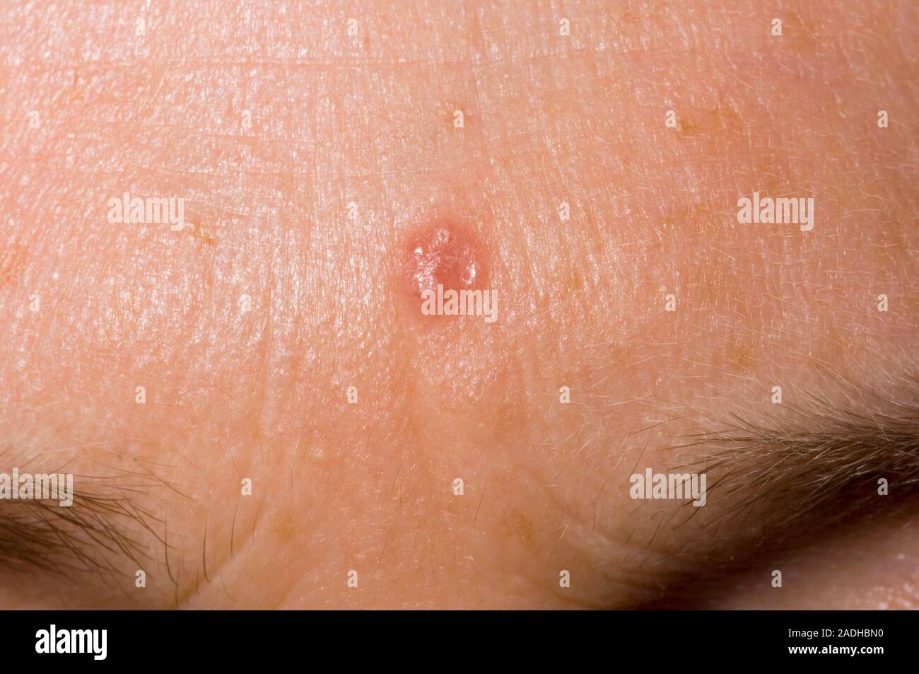 Basal Cell Carcinoma Bcc Or Rodent Ulcer On A 59 Year Old Mans Forehead This Is The Most