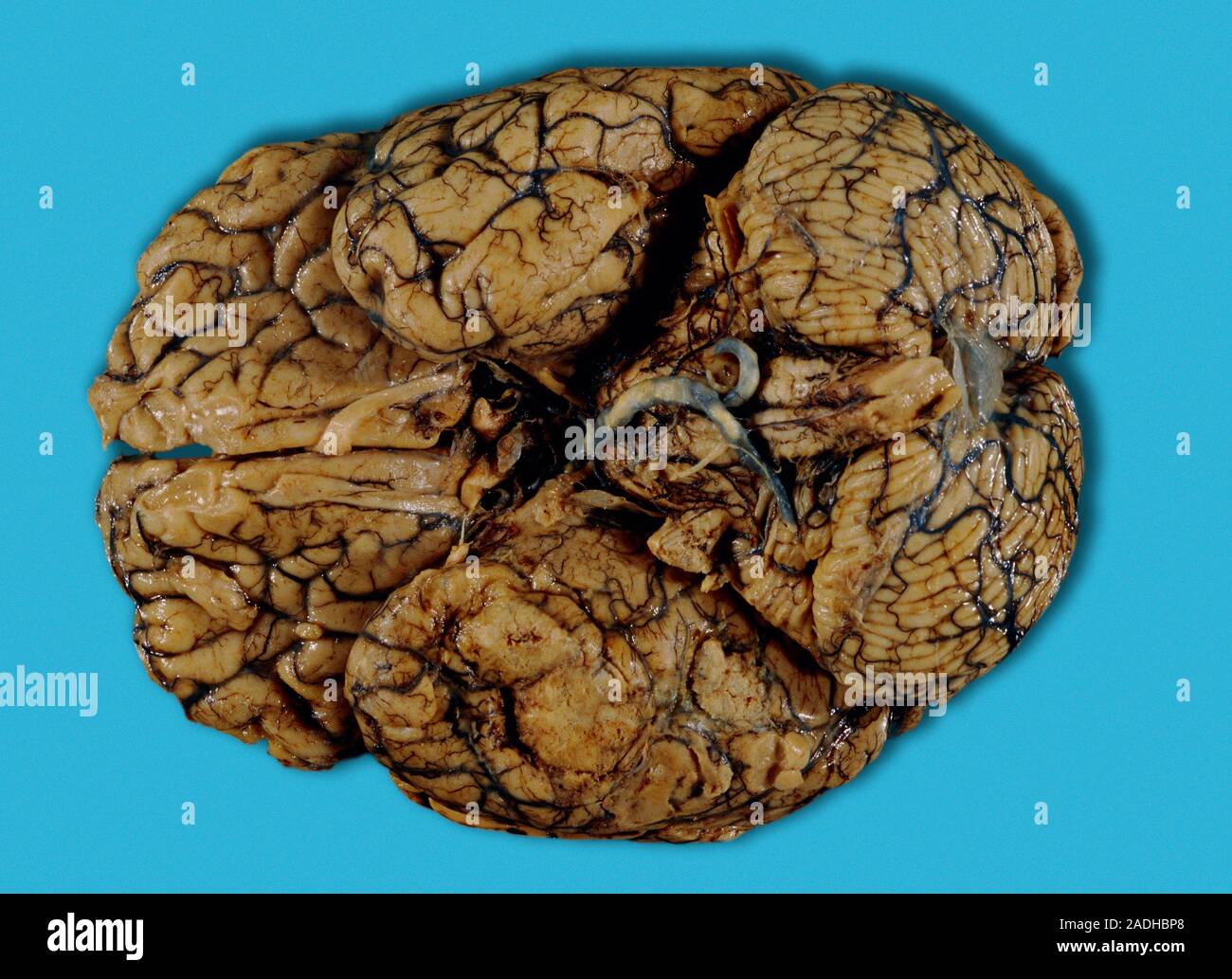 Brain cancer, gross specimen. View of the underside of a brain with the ...