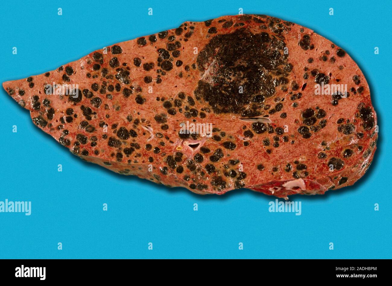 Liver cancer, gross specimen. Typical pigmented tumours resulting from ...