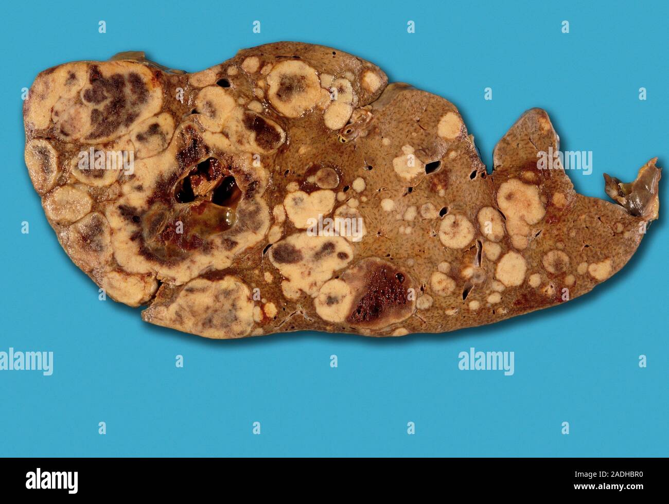 Liver Cancer Gross Specimen Of Malignant Carcinoids In The Liver Carcinoid Tumours Are Slow