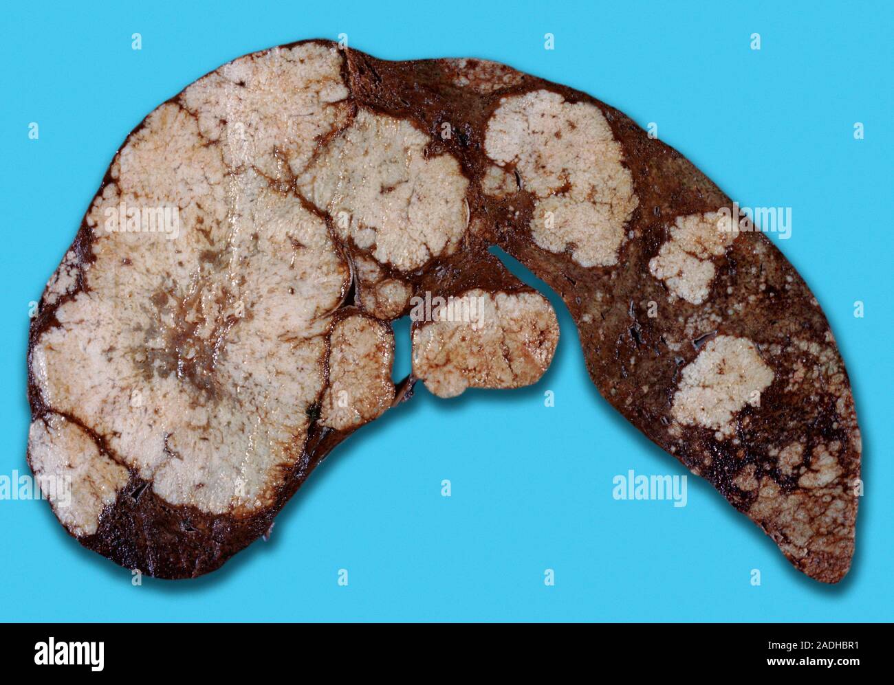 Liver Cancer Gross Specimen Multiple Tumours Resulting From Metastatic Carcinoma Of The Liver