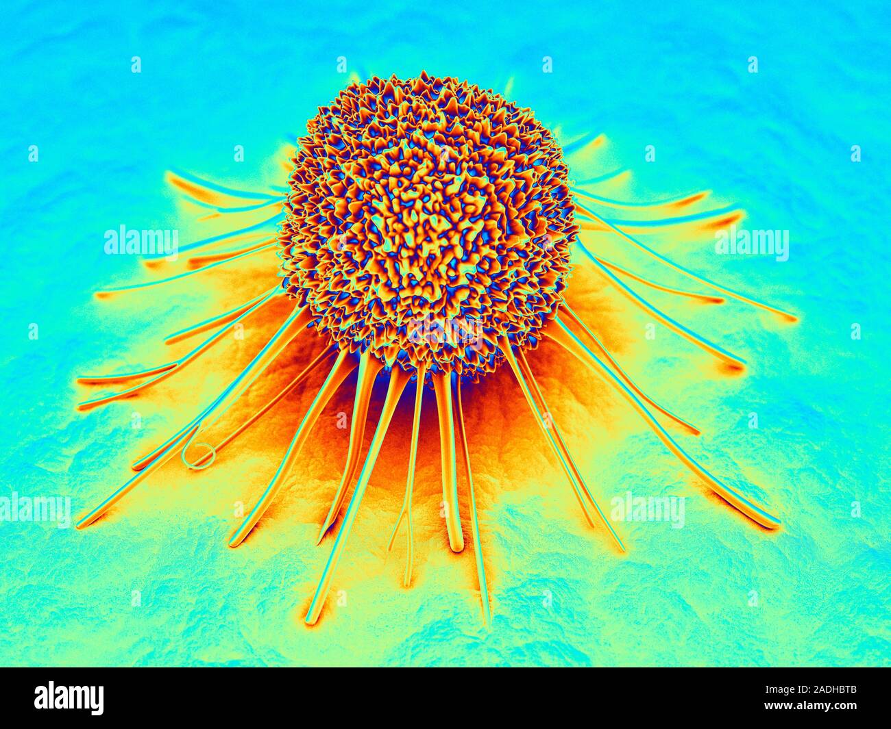 Cancer cell, computer artwork. The uneven surface and cytoplasmic ...