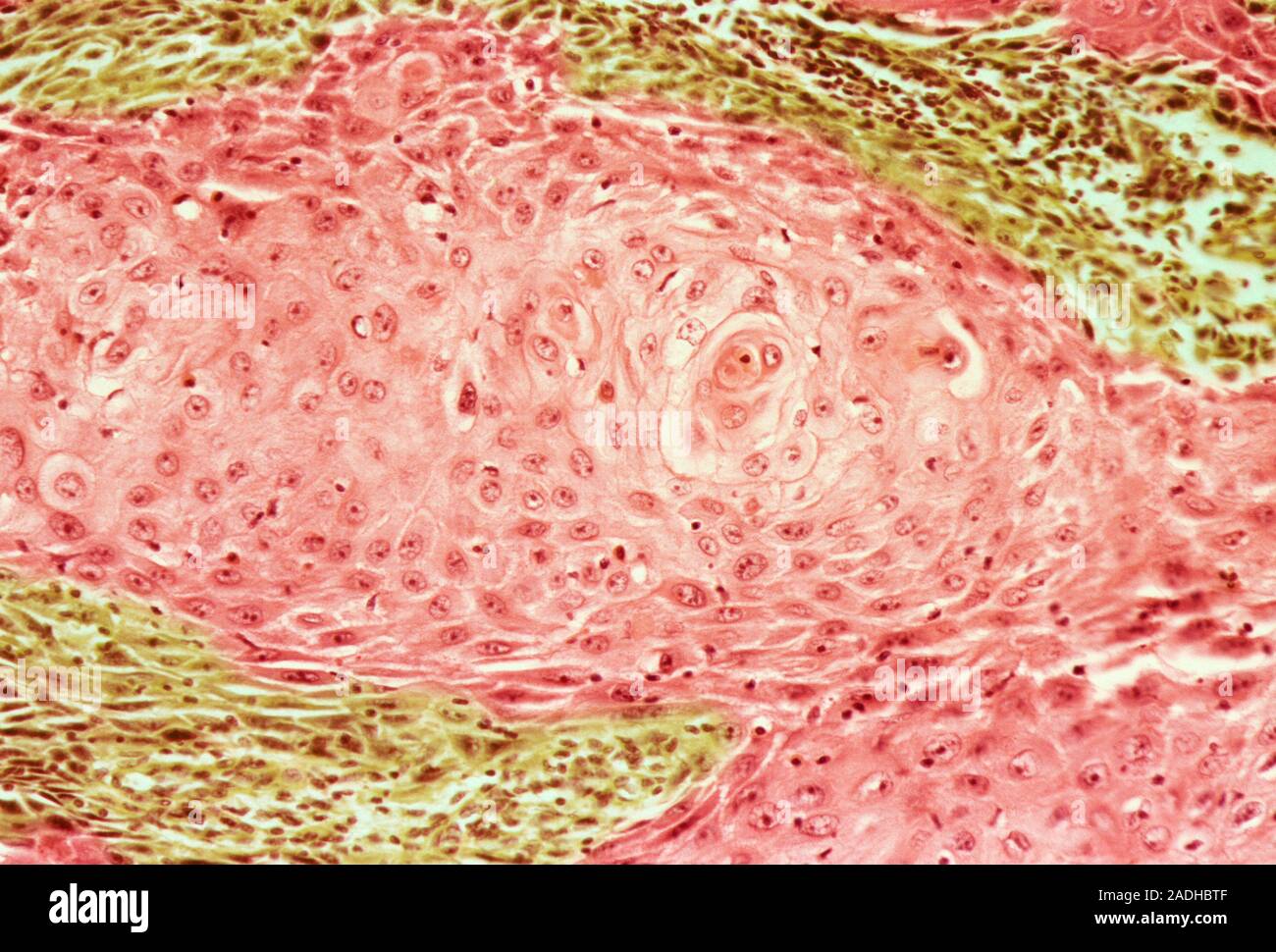 Squamous cell carcinoma (SCC). Light micrograph (LM) of SCC cells (pink ...