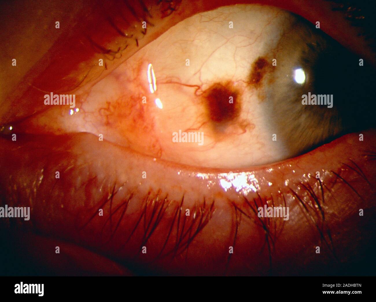 Eye cancer. Malignant (cancerous) melanoma tumour (dark patch at upper ...