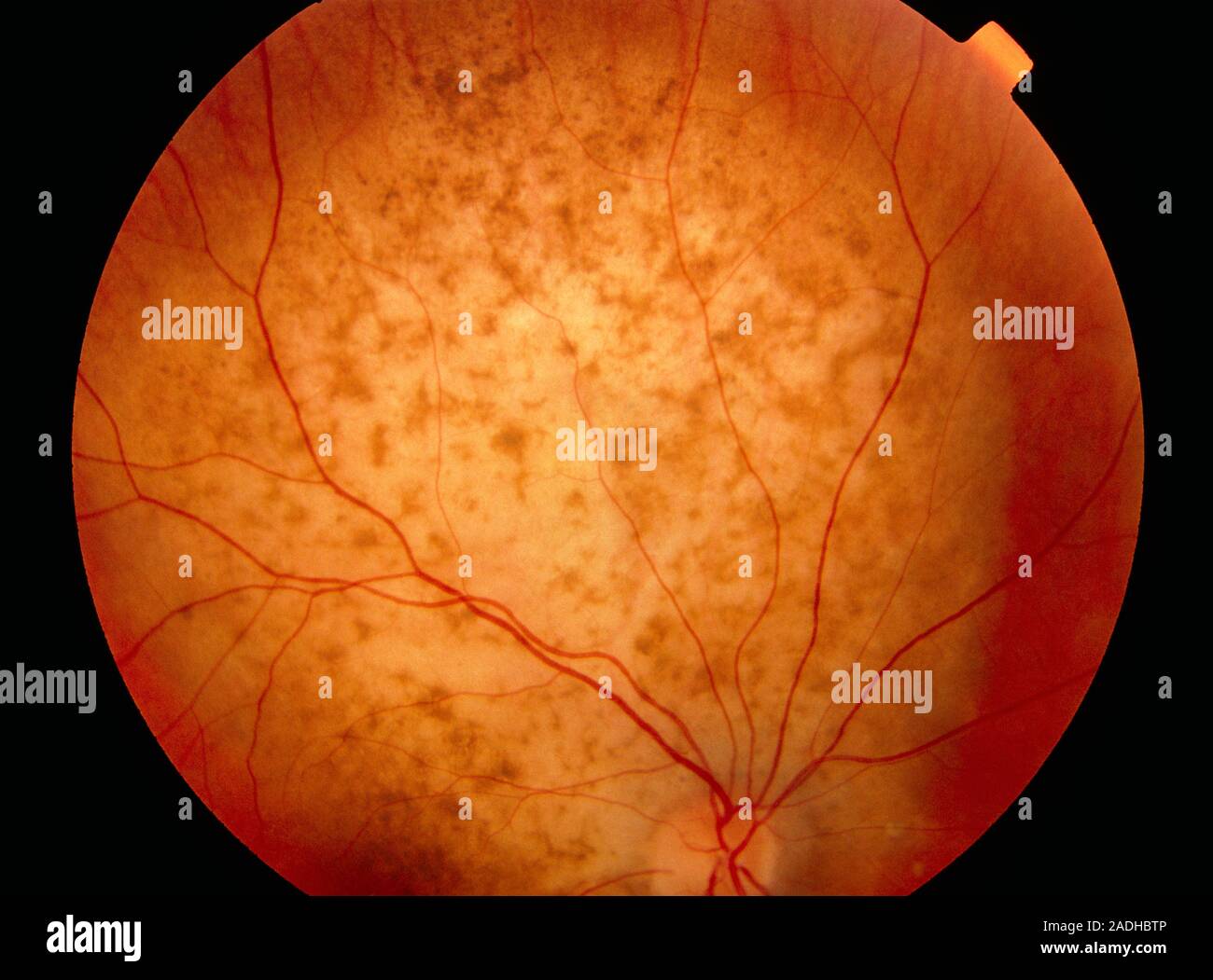 Eye cancer, ophthalmoscope view. Intraocular lymphoma is a rare form of ...
