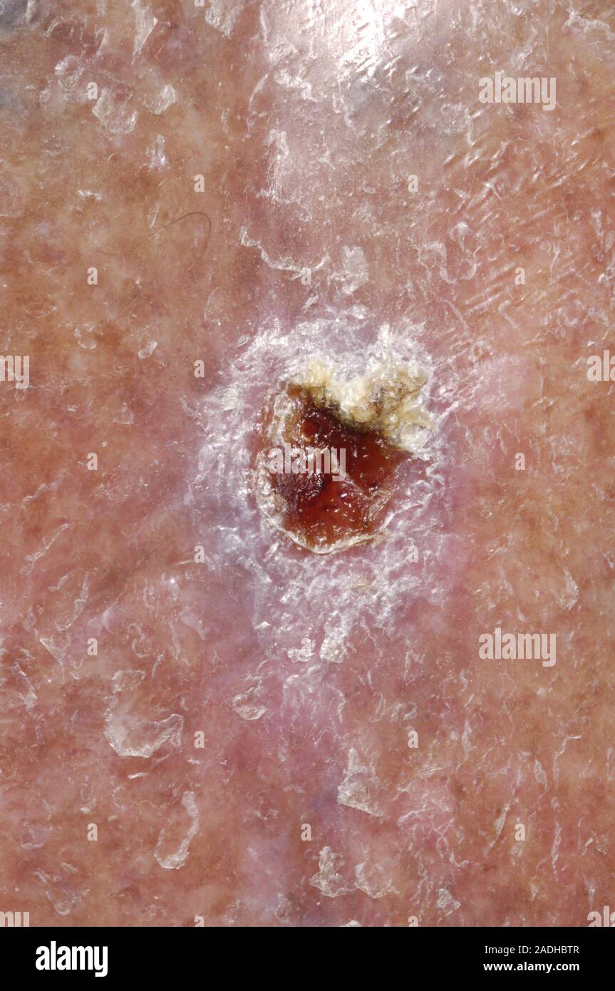 Basal cell carcinoma. Close-up of a raised, bleeding, ulcer-like growth ...
