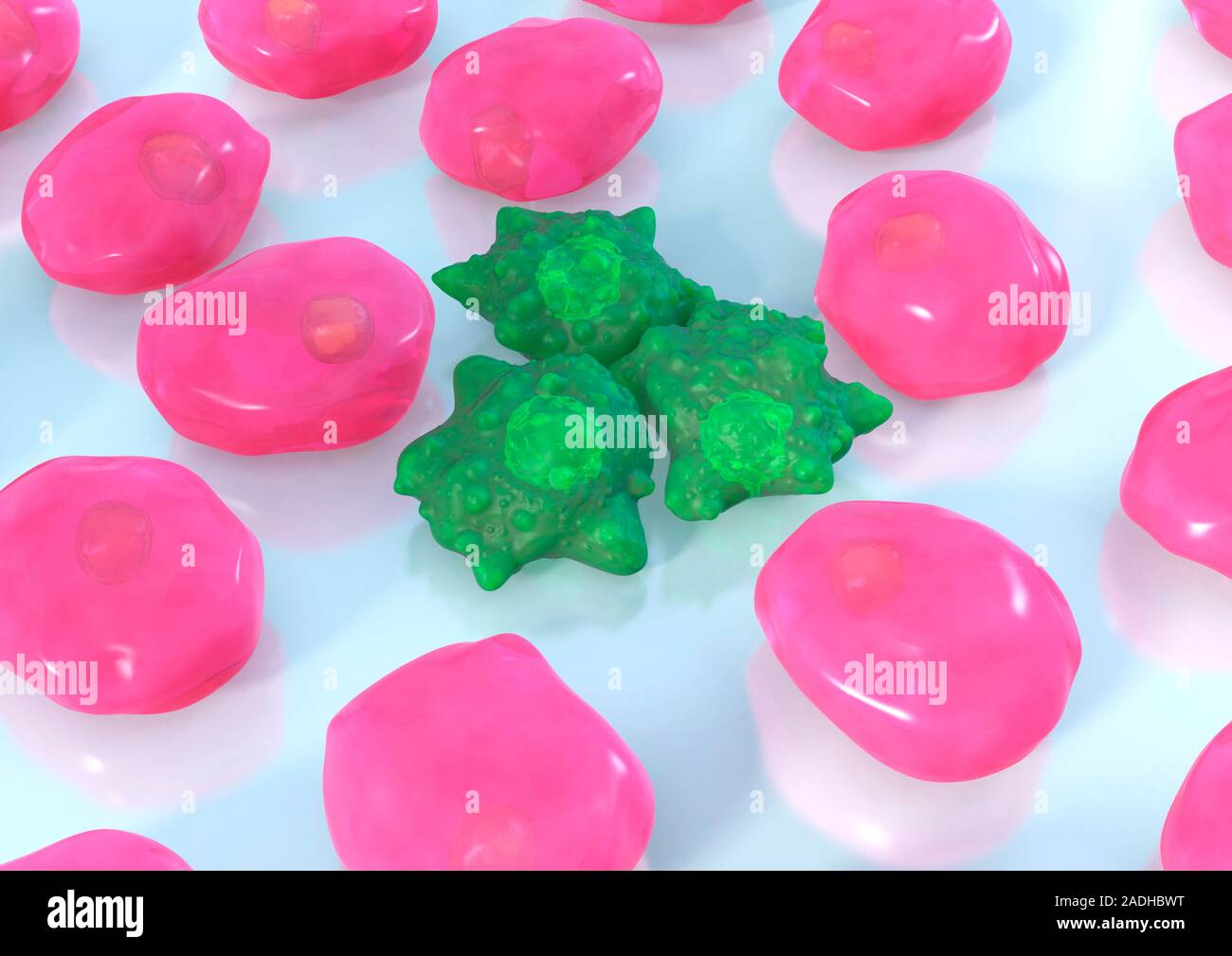 Cancer, conceptual artwork. Here, malignant (cancerous) cells (green ...