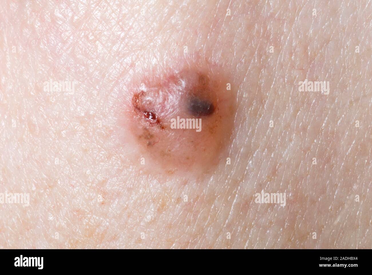 Basal cell carcinoma (BCC), or rodent ulcer, on a 64 year old woman's ...