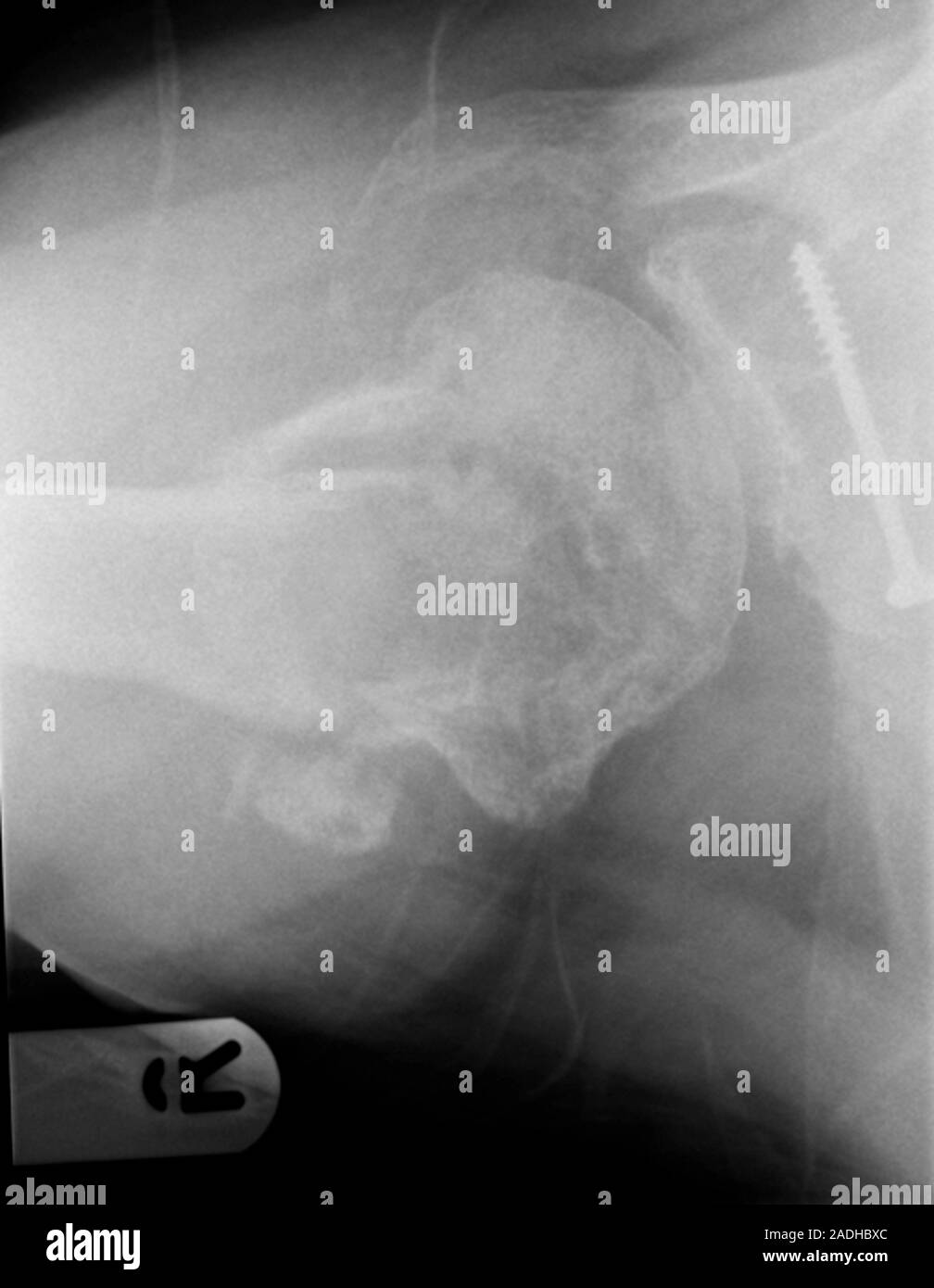 Bone cancer. X-ray image of the shoulder of a 51 year old man with a ...