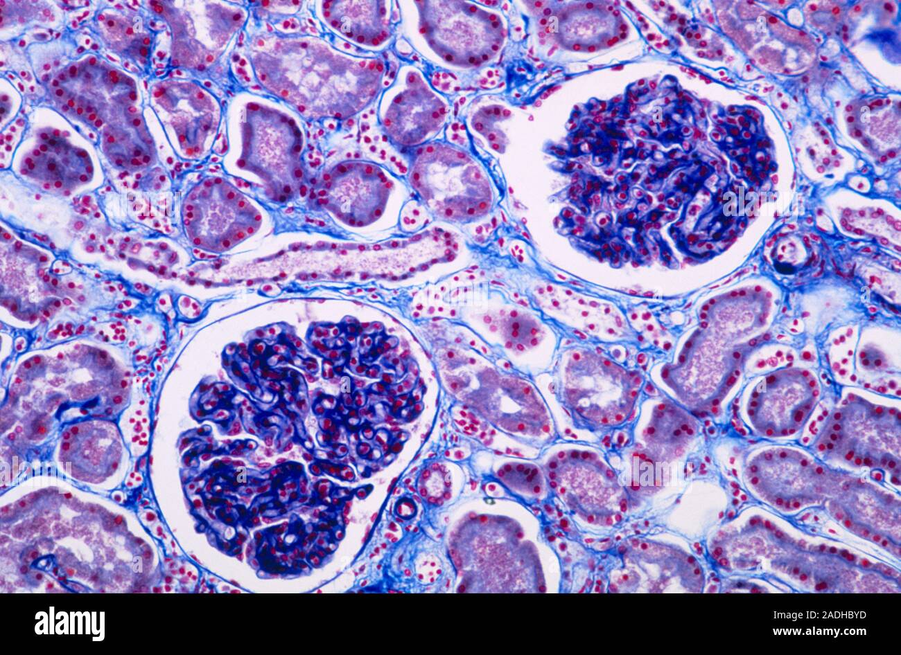 Light micrograph of a section of kidney showing evidence of leukaemia ...