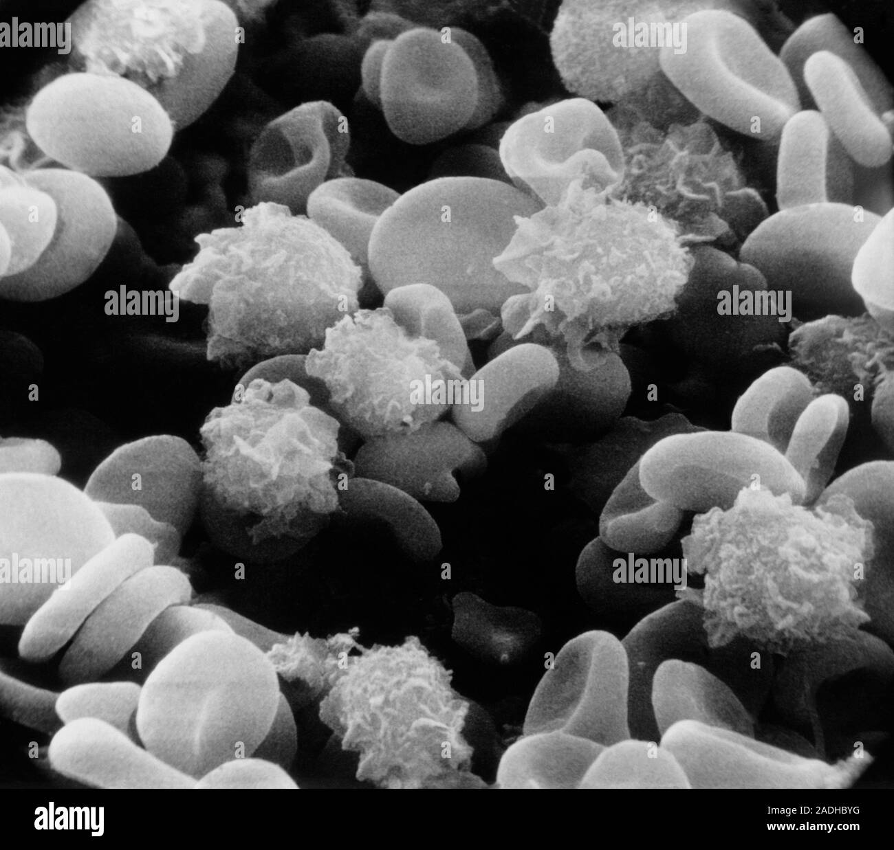 Scanning electron micrograph of 'hairy cell' leukaemia (HCL) showing B ...