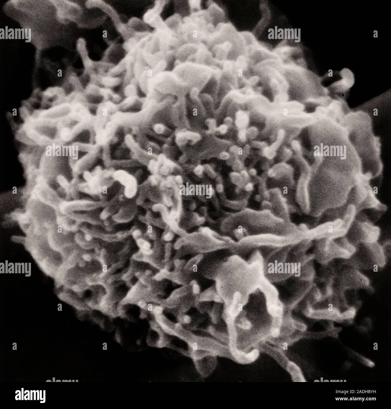 Scanning electron micrograph of a 'hairy cell' in 'hairy cell ...