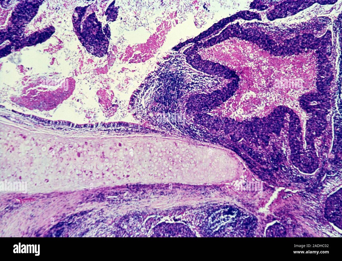 Light micrograph showing squamous cell carcinoma (cancer) of the human ...
