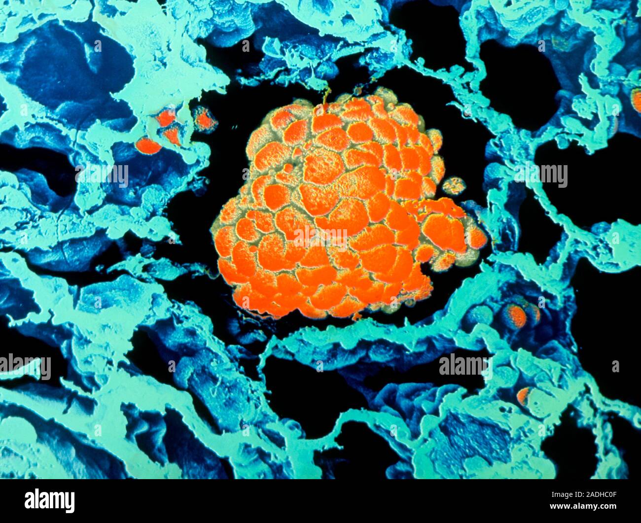 Lung cancer. False-colour scanning electron micrograph (SEM) of a tiny ...