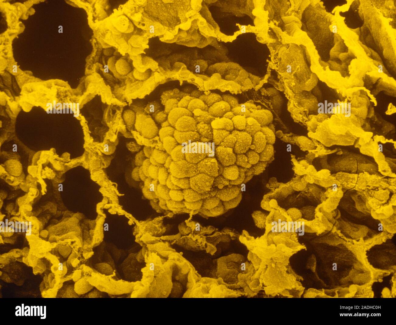 Lung cancer. False-colour Scanning electron micrograph of a tiny lung ...