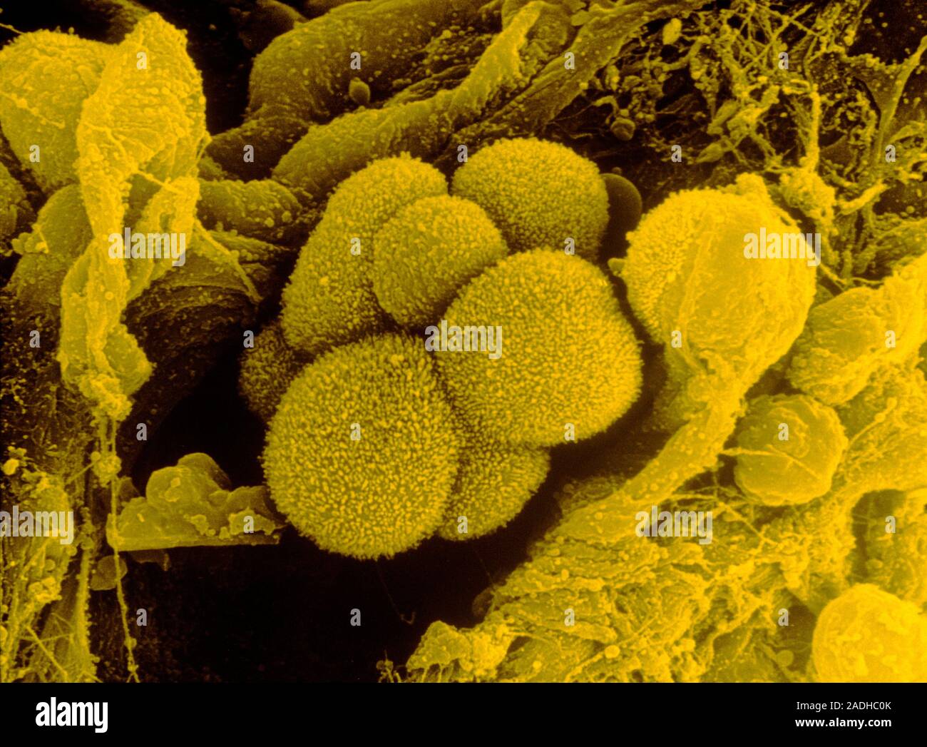 Lung cancer. False-colour scanning electron micrograph of a tiny lung ...