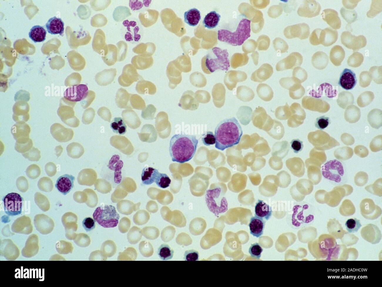 Chronic lymphocytic leukaemia. Light micrograph of a bone marrow film ...