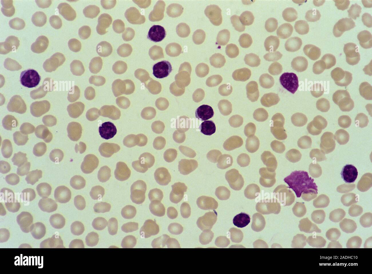 Light micrograph of a blood film from a patient with acute lymphoblastic leukaemia (ALL) showing ...