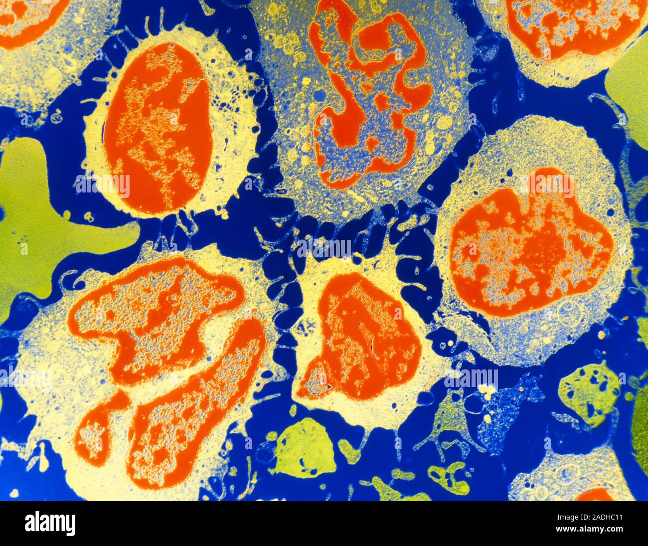 Hairy-cell leukaemia. False-colour transmission electron micrograph of ...