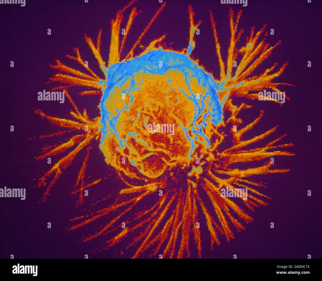 False-colour scanning electron micrograph (SEM) of a single cancer cell ...