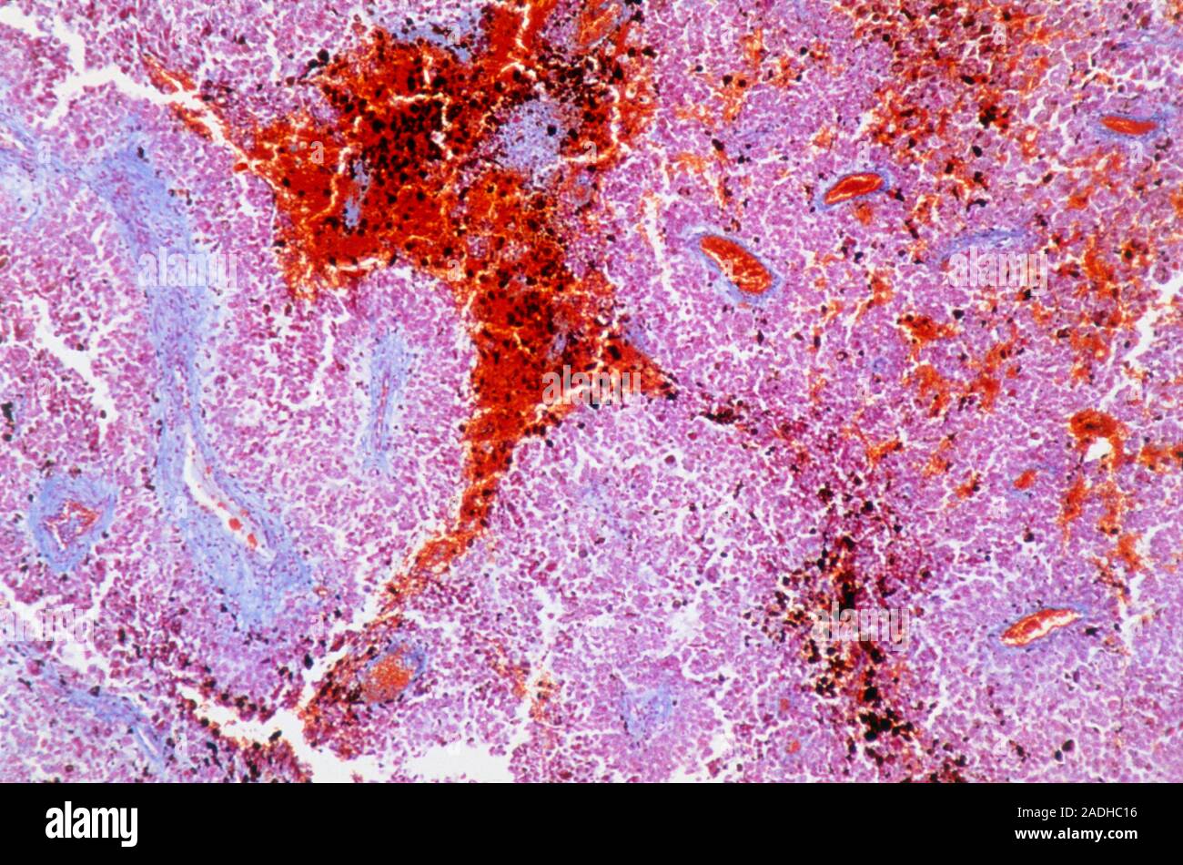 Light micrograph of a human liver, showing a metastasised melanosarcoma ...