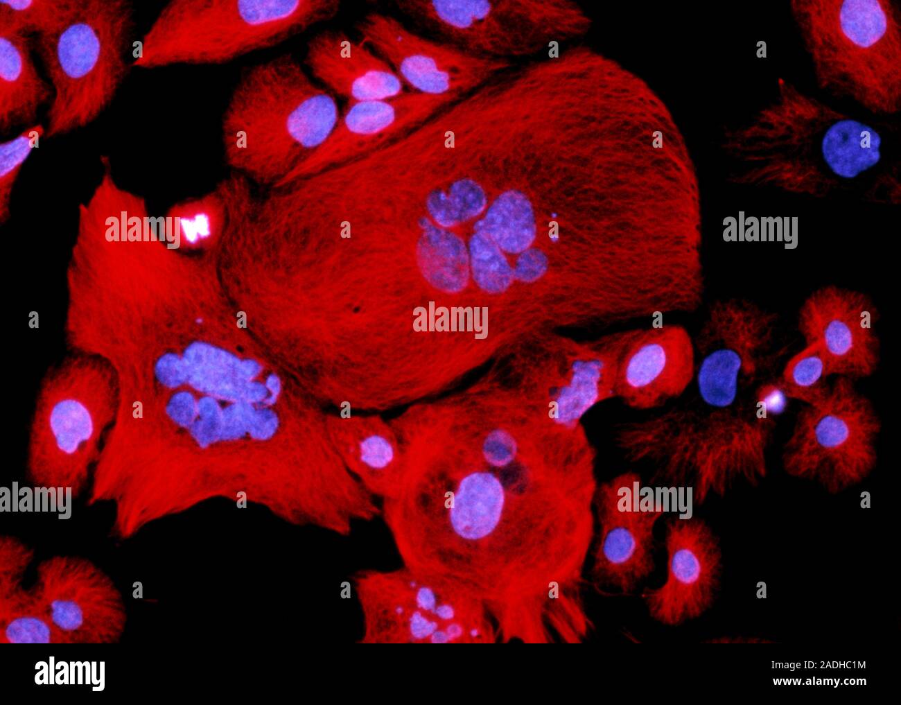 Immunofluorescent Light Micrograph of cancer cells of the human bladder ...
