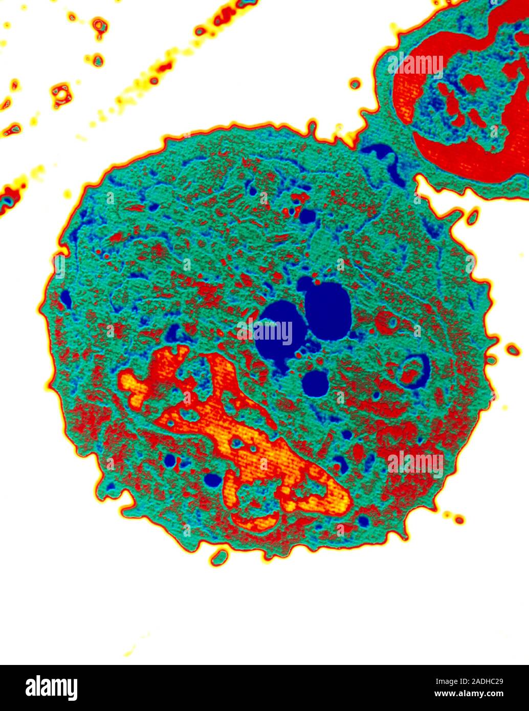 Cancer cell. Coloured transmission electron micro- graph (TEM) of a ...