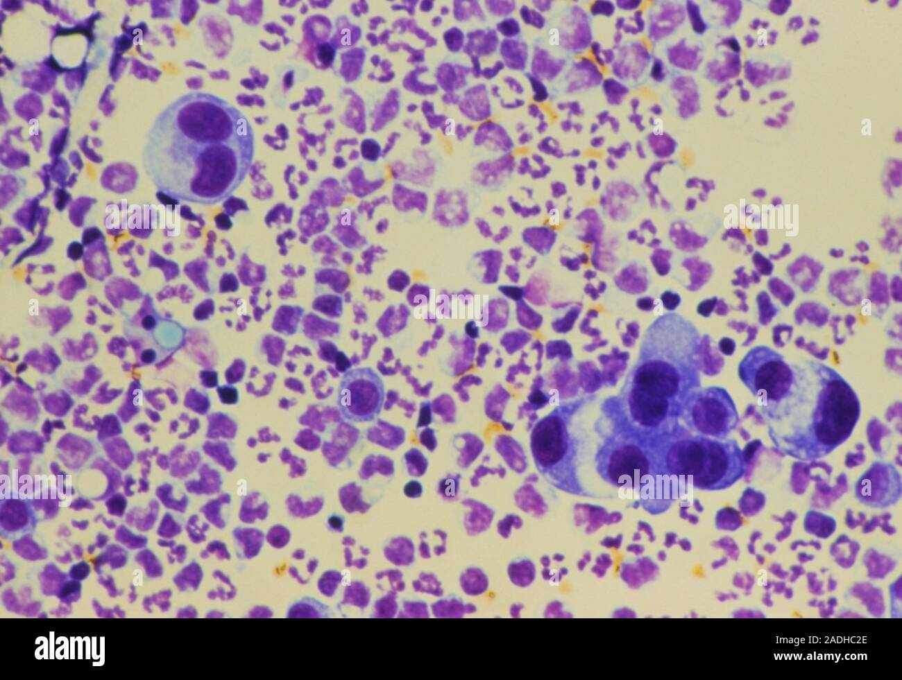 Cancer cells in ascitic fluid. Light micrograph of cancerous (malignant ...