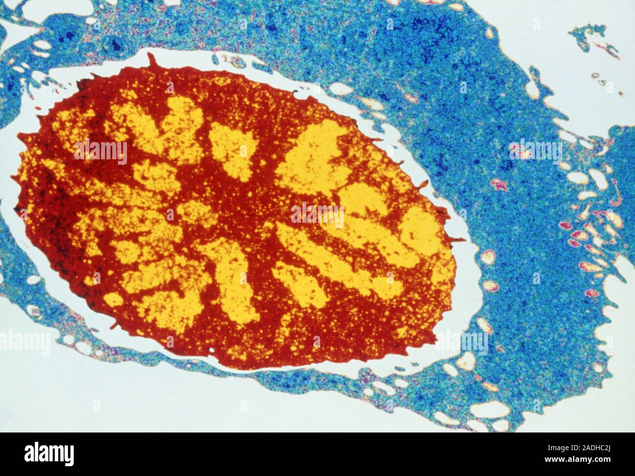 Cancer cell eaten by macrophage. Coloured Trans- mission Electron ...