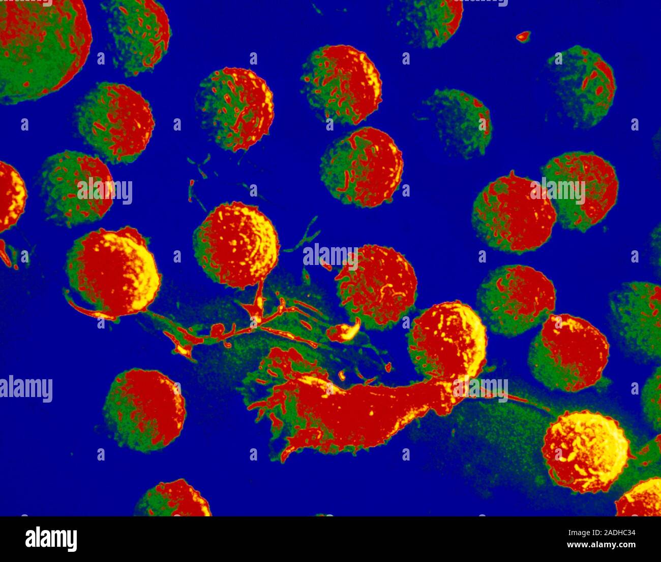 Leukaemic white blood cells. Coloured scanning electron micrograph of ...