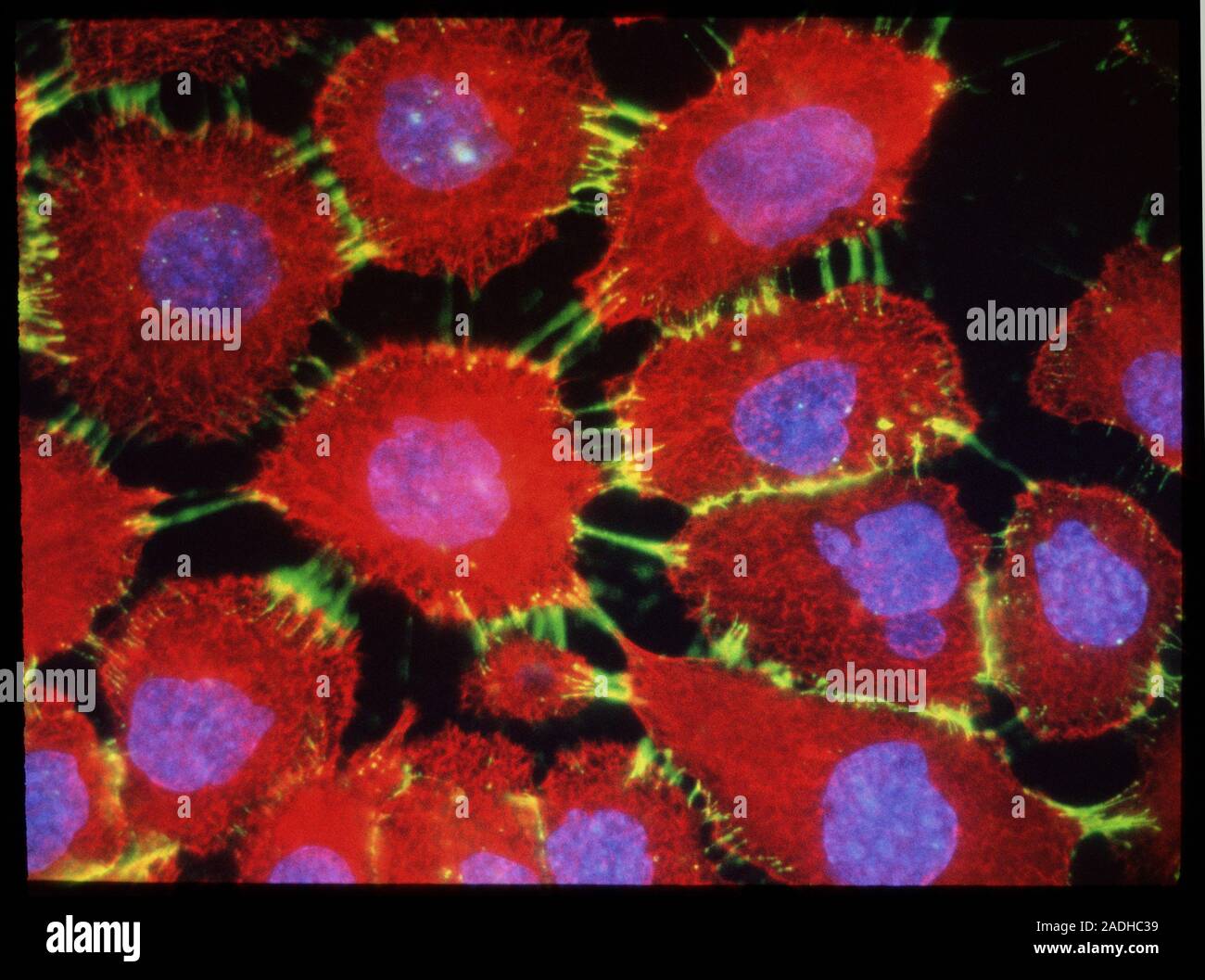 Bladder cancer. Immunofluorescent light micrograph of cells cultured ...