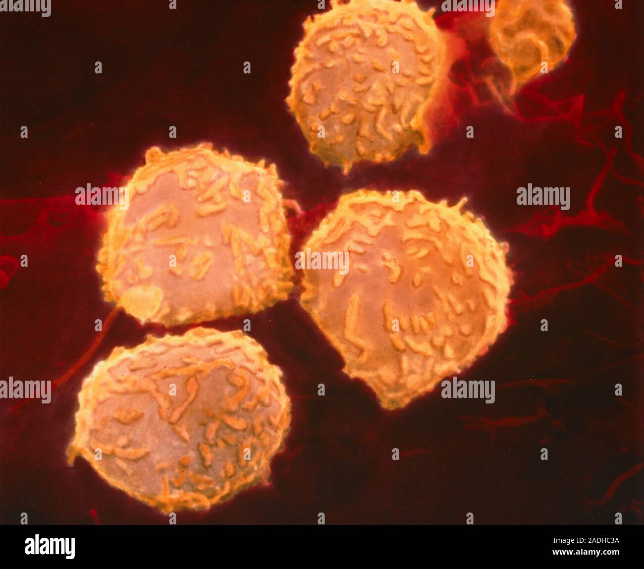 Leukaemic white blood cells. Coloured scanning electron micrograph of ...