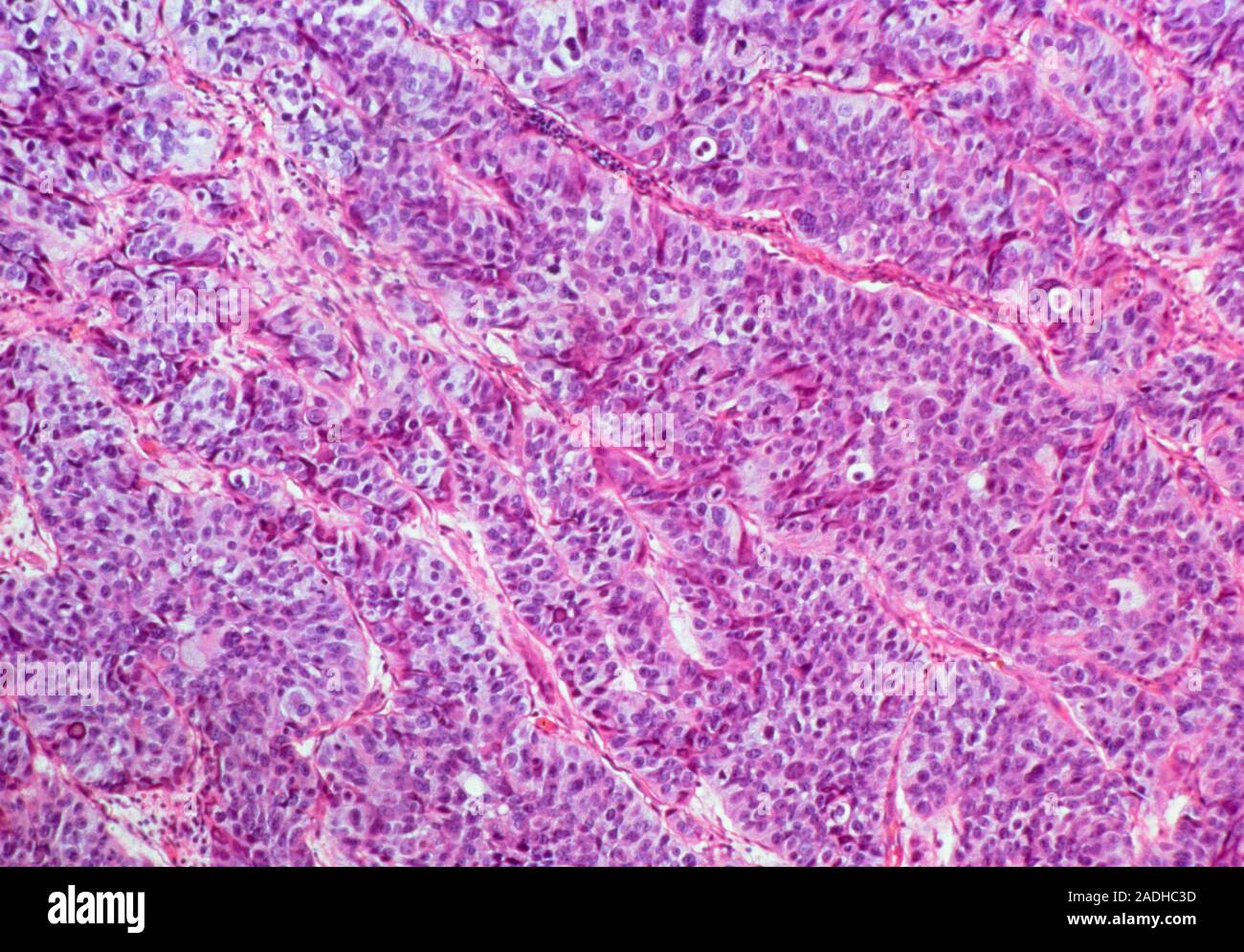Bladder cancer. Light micrograph of a section through a transitional ...