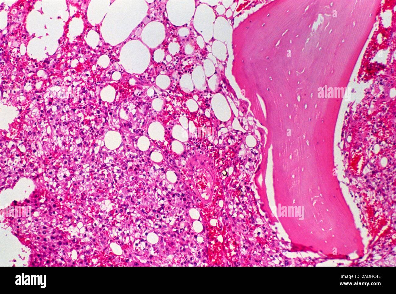Secondary bone cancer. Light micrograph of a secondary (metastatic ...
