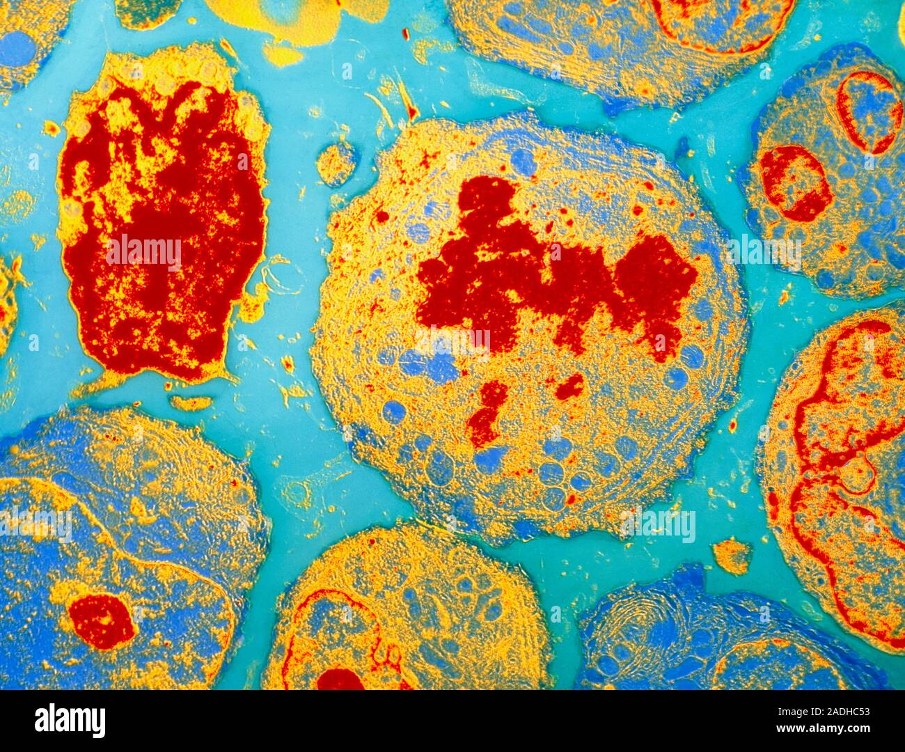 Plasmacytoma. Coloured transmission electron micrograph (TEM) of ...