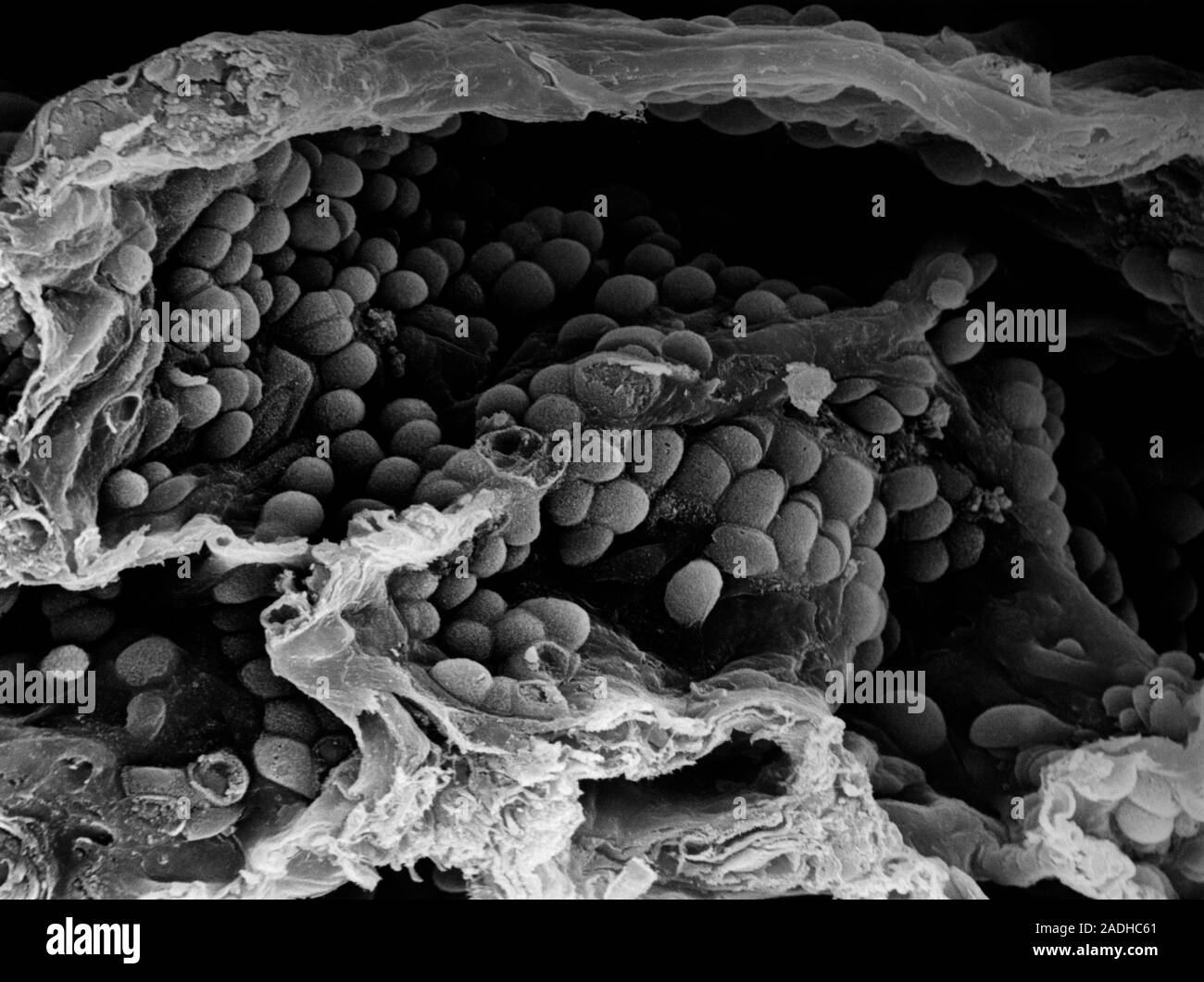 Lung cancer. Scanning electron micrograph of cancer cells proliferating ...