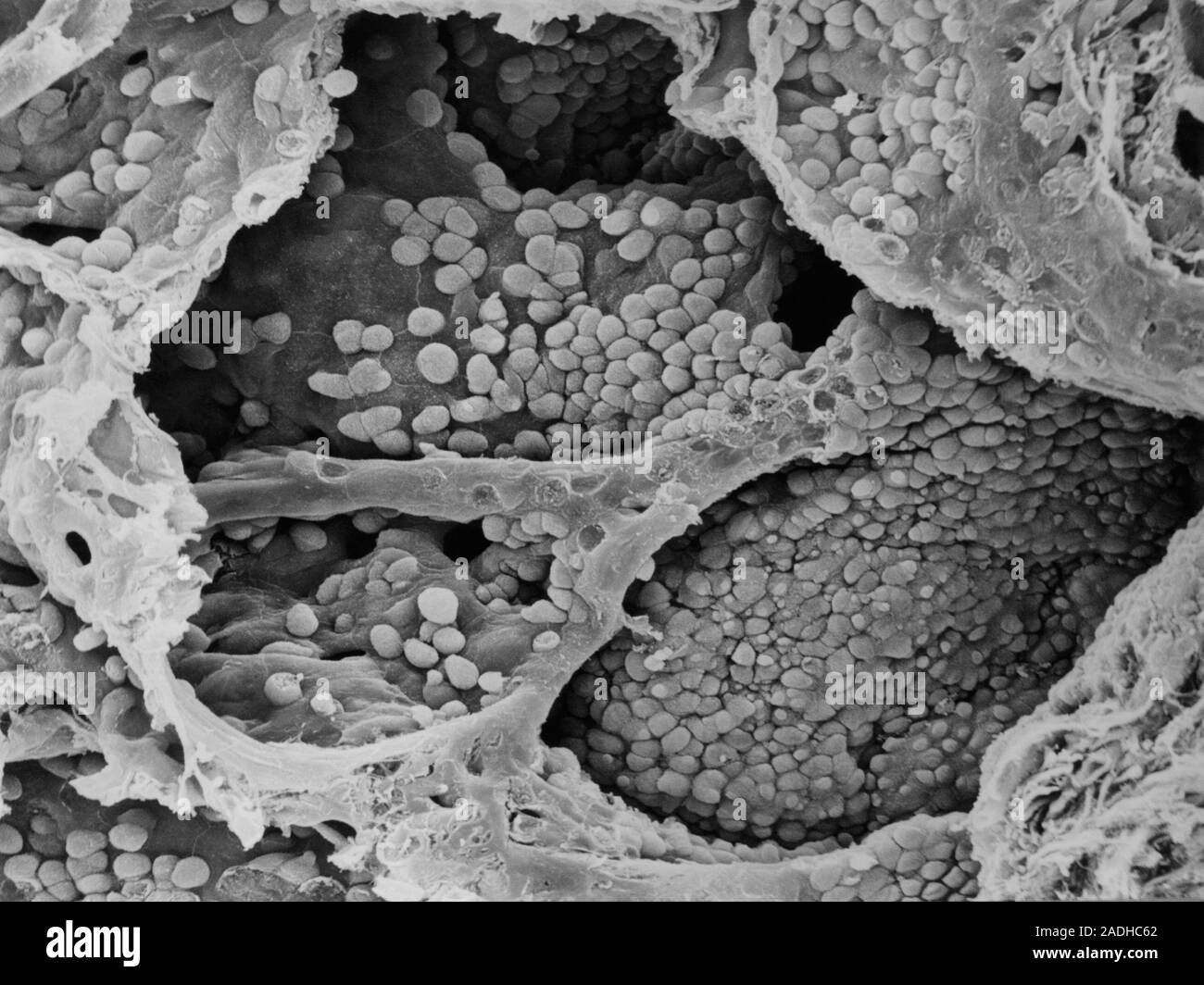 Lung cancer. Scanning electron micrograph of cancer cells proliferating ...