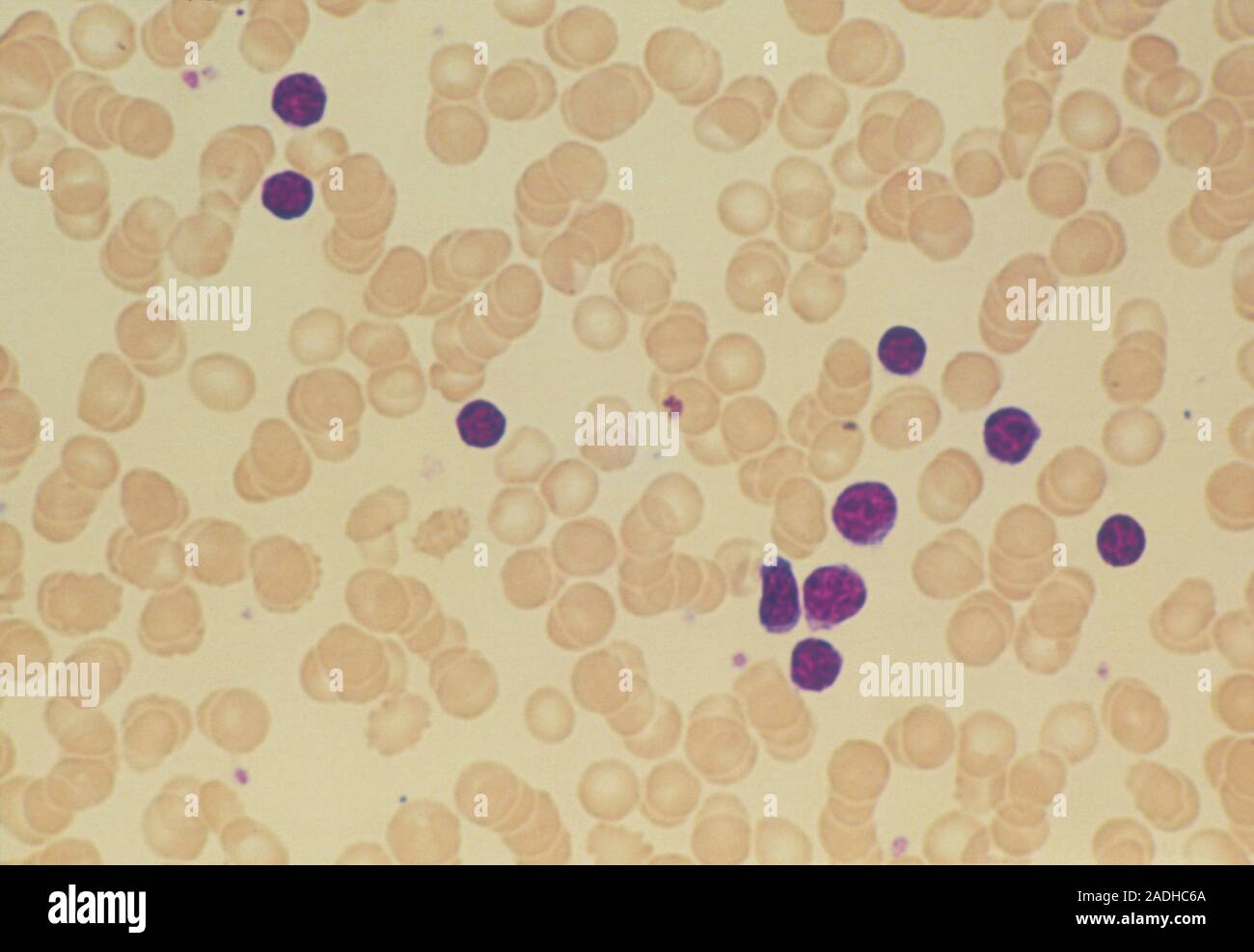 Chronic lymphocytic leukaemia. Light micrograph of cancerous blood ...