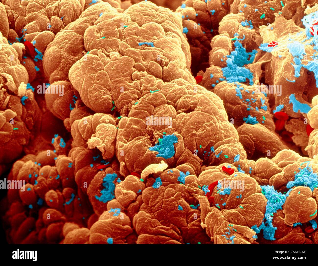 Colon cancer. Coloured Scanning Electron Micro- graph (SEM) of the ...
