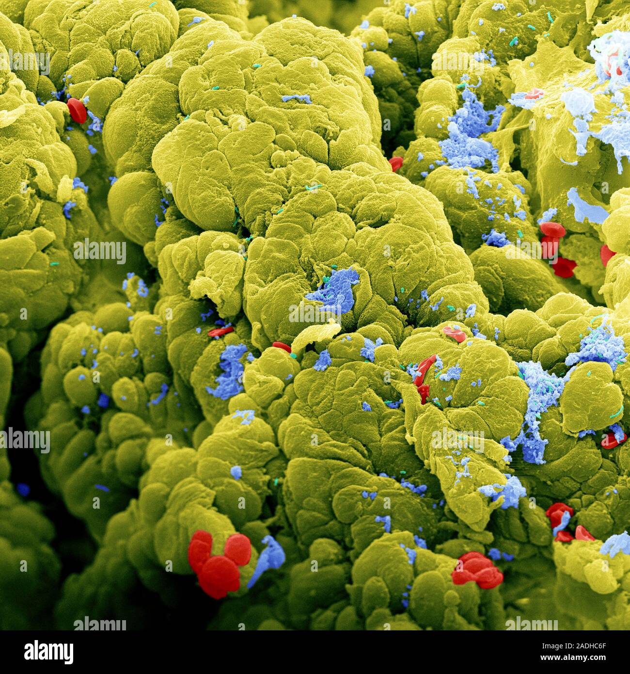 Colon cancer. Coloured Scanning Electron Micro- graph (SEM) of the ...