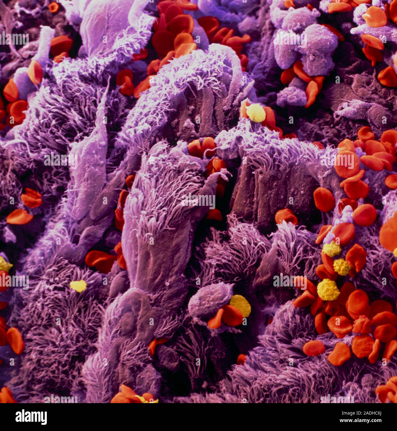 Bronchus lung cancer. Coloured Scanning Electron Micrograph (SEM) of ...