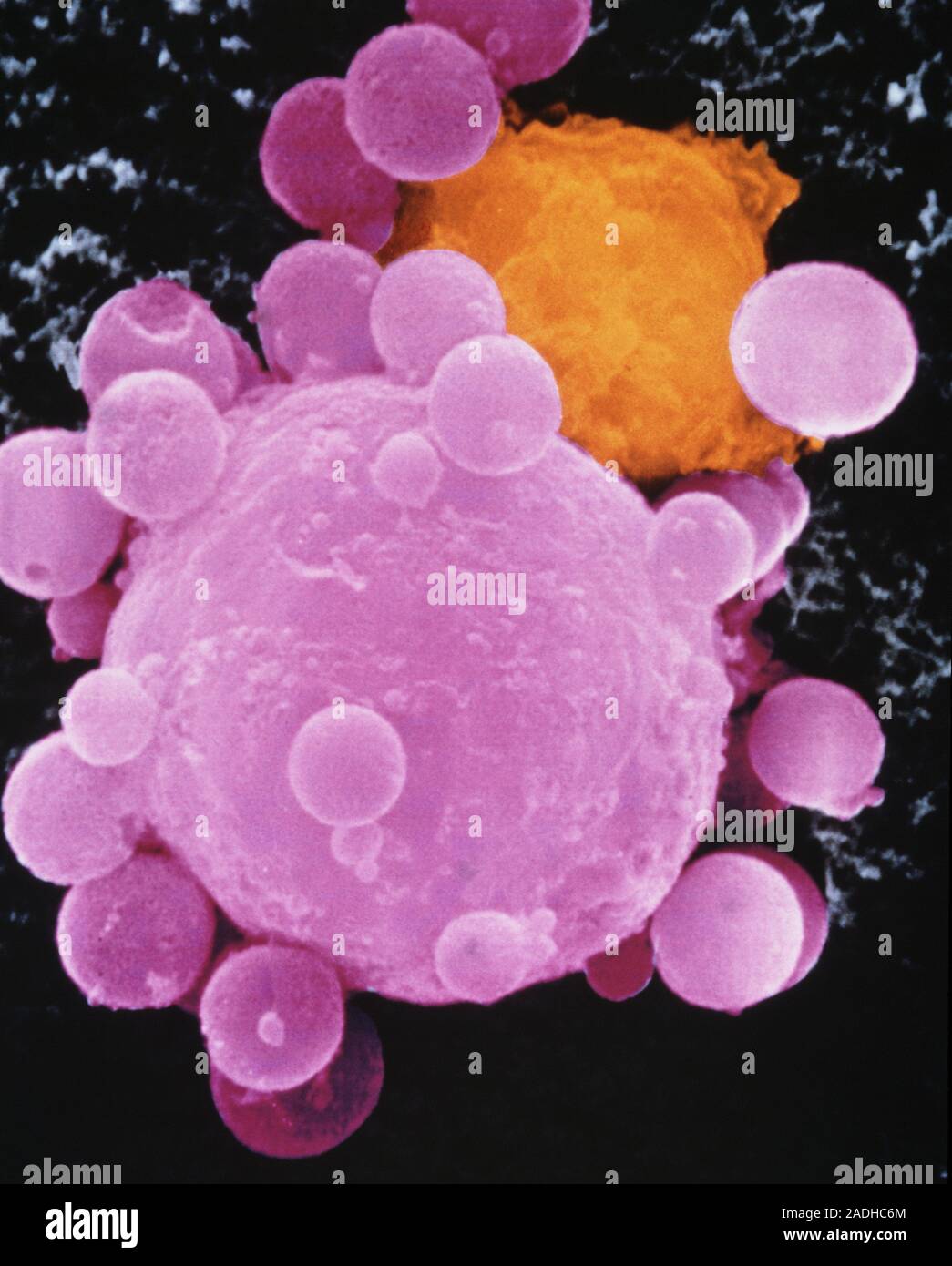 Cancer cell death. Coloured Scanning Electron Micrograph (SEM) showing ...